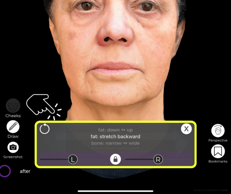 How to Simulate a Facelift - Arbrea Face Academy